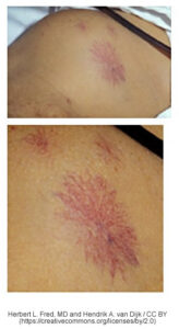 SPIDER VEINS