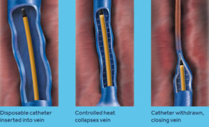 TREATMENT OF VEIN DISEASES