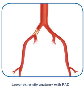 PERIPHERAL ARTERIAL DISEASE (PAD)